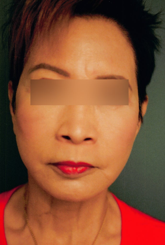 Asian Facial Rejuvenation | Vancouver Cosmetic Surgery