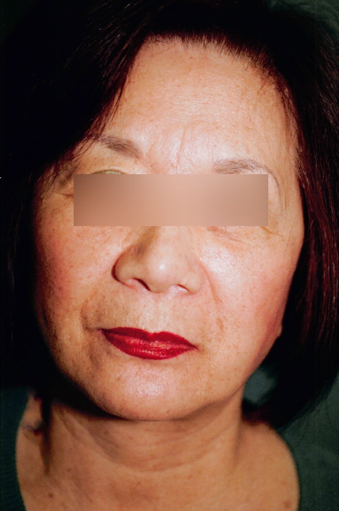 Asian Facial Rejuvenation | Vancouver Cosmetic Surgery