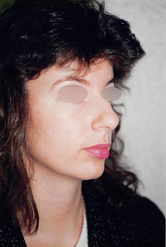 CHIN IMPLANTS - Dr. Lorne Brown