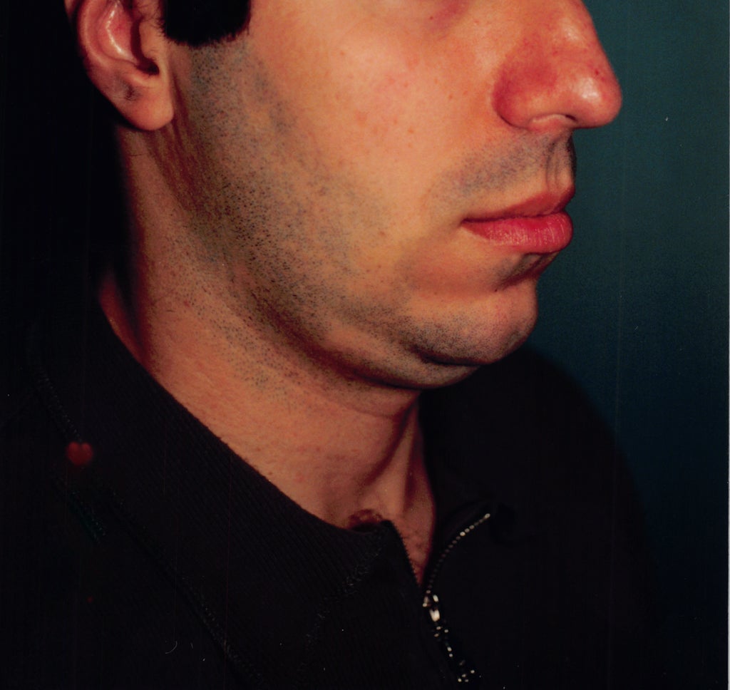 CHIN IMPLANTS - Dr. Lorne Brown