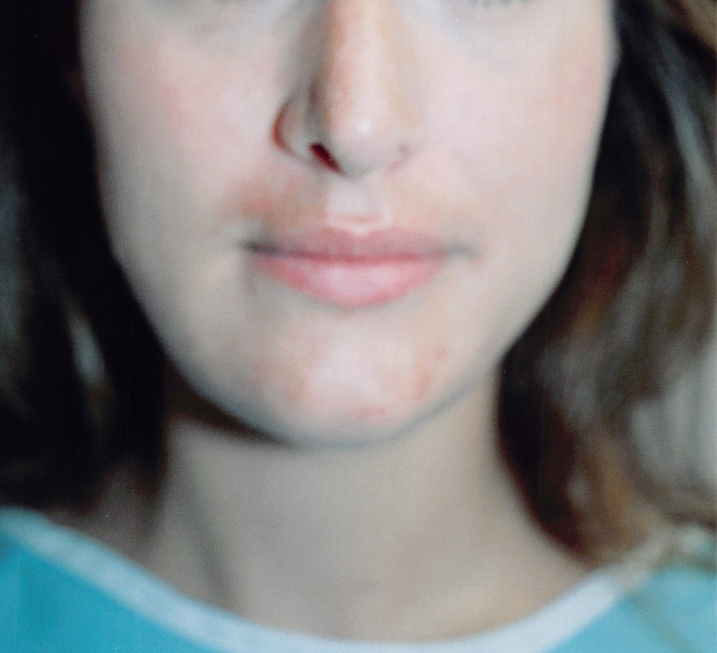 CHIN IMPLANTS - Dr. Lorne Brown